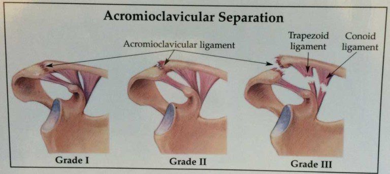 Acromioclavicular Ligament Tear - A Simple Life of Luxury