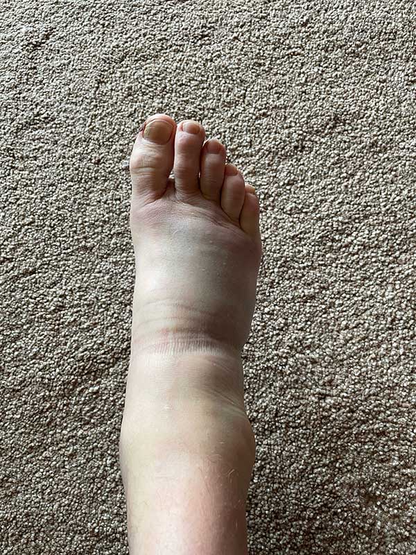 Foot Injury Updates - A Simple Life of Luxury